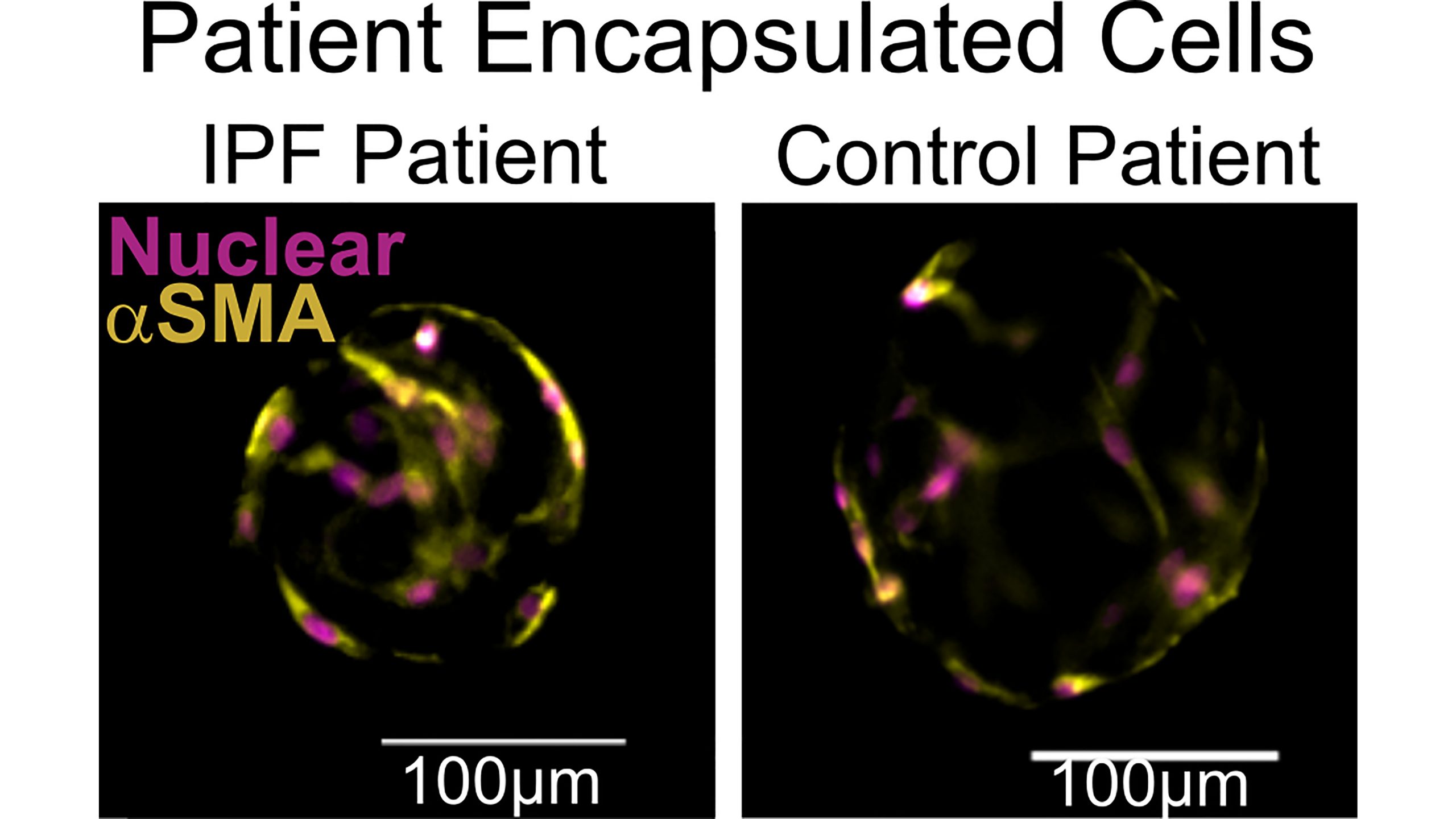 Microtissue System Allows Study of Deadly Lung Disease - AIP Publishing LLC